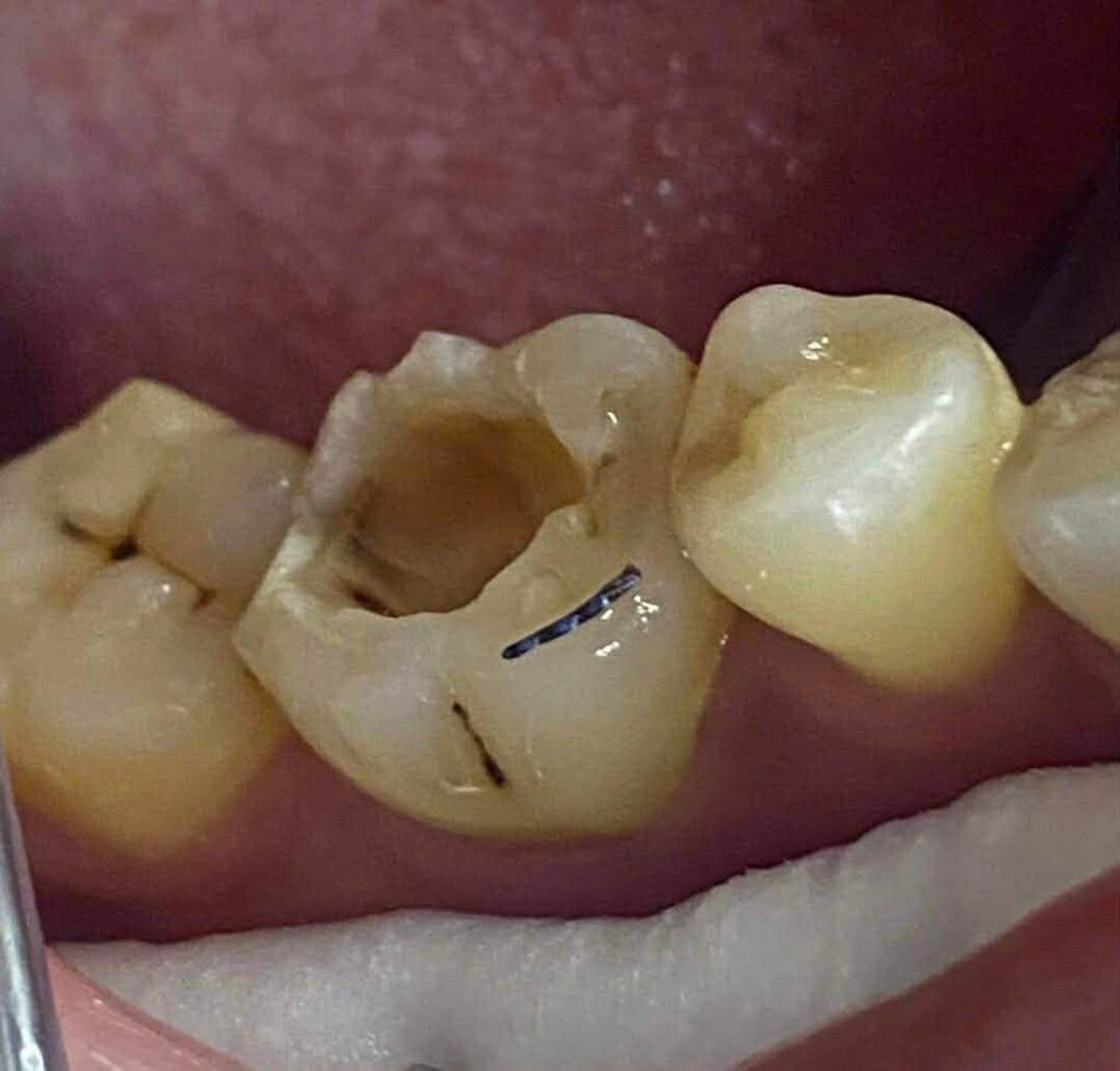 Lấy File Gãy Trong Điều Trị Nội Nha – Hướng Dẫn Chi Tiết Cho Bác Sĩ ...